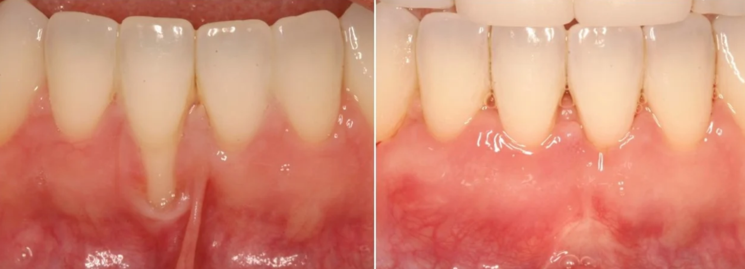 Periodontal Splinting and Tissue Grafting – SEAVIEW DENTAL STAFFORD